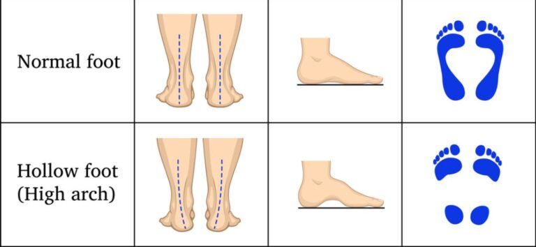 About High Arches
